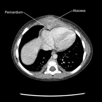 Pre-sternal mass with a congenital sternal defect: a rare presentation ...