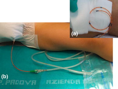 Complications of trans-anastomotic externalised stents in open ...