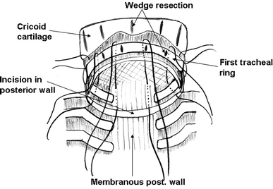 Laryngotracheal separation using skin flap formation: a novel surgical ...