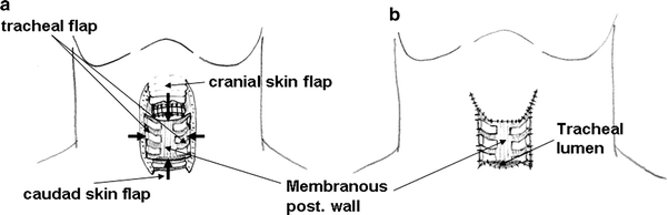 Laryngotracheal separation using skin flap formation: a novel surgical ...