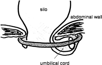 Umbilical cord inverting technique: a simple method to utilize the ...