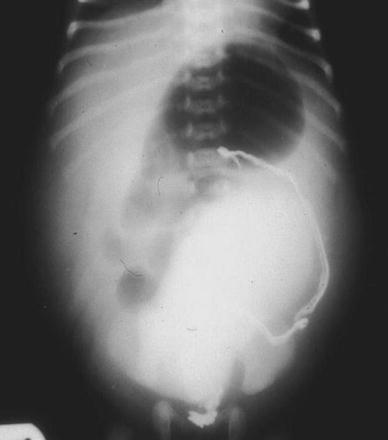 Megacystis microcolon intestinal hypoperistalsis syndrome: systematic ...