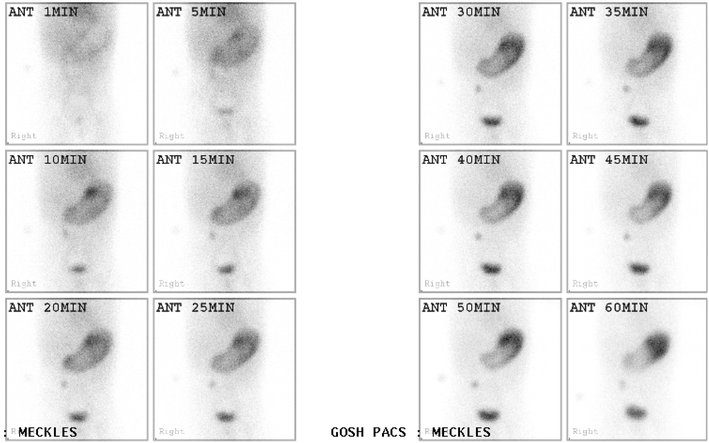 Meckel’s scan in children: a review of 183 cases referred to two ...