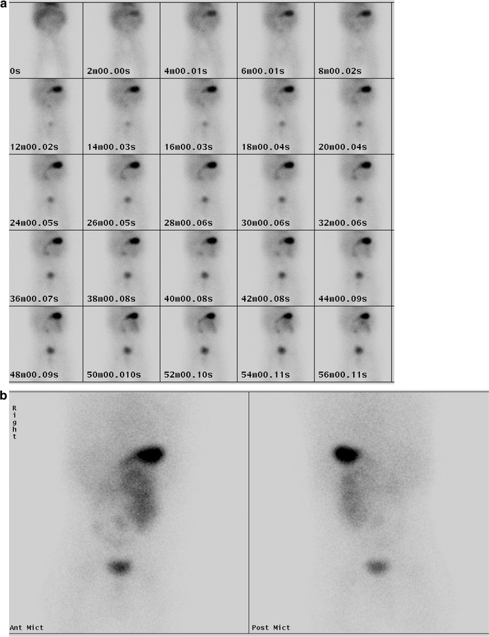 Meckel’s scan in children: a review of 183 cases referred to two ...