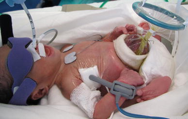 Staged gastroschisis closure using Alexis wound retractor: first ...