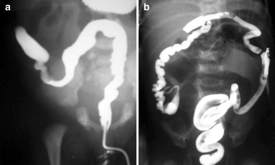 Total colonic aganglionosis and Hirschsprung’s disease: a review ...