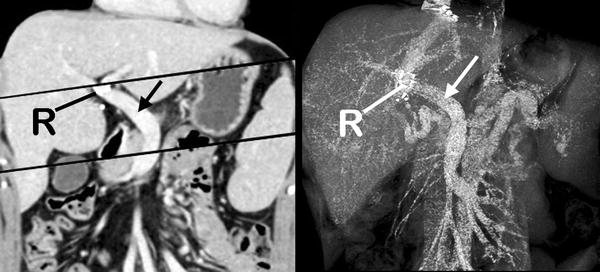 Meso-Rex bypass to manage prehepatic portal hypertension after the ...