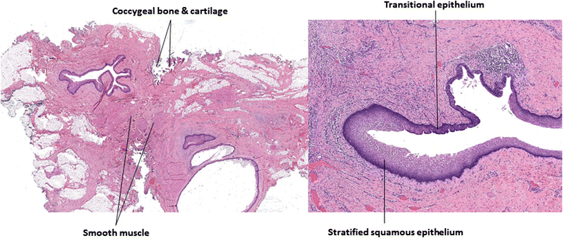 Tailgut cysts in children: a report of two cases and literature review ...