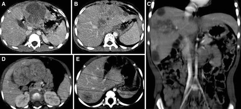 PRETEXT II–III multifocal hepatoblastoma: significance of resection of ...