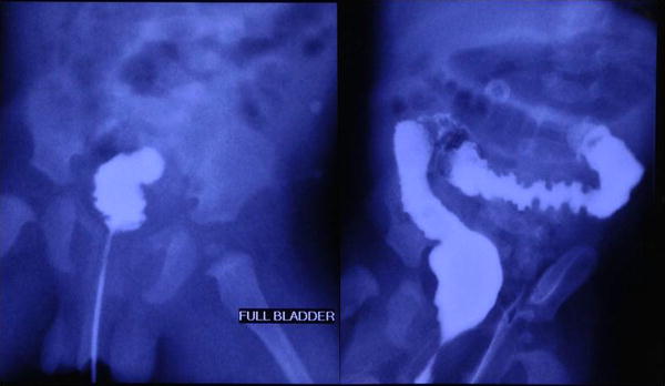 Male cloaca malformation: rare variant of anorectal malformation ...