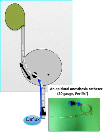 Ureteric patency after Deflux® injection for the treatment of ...