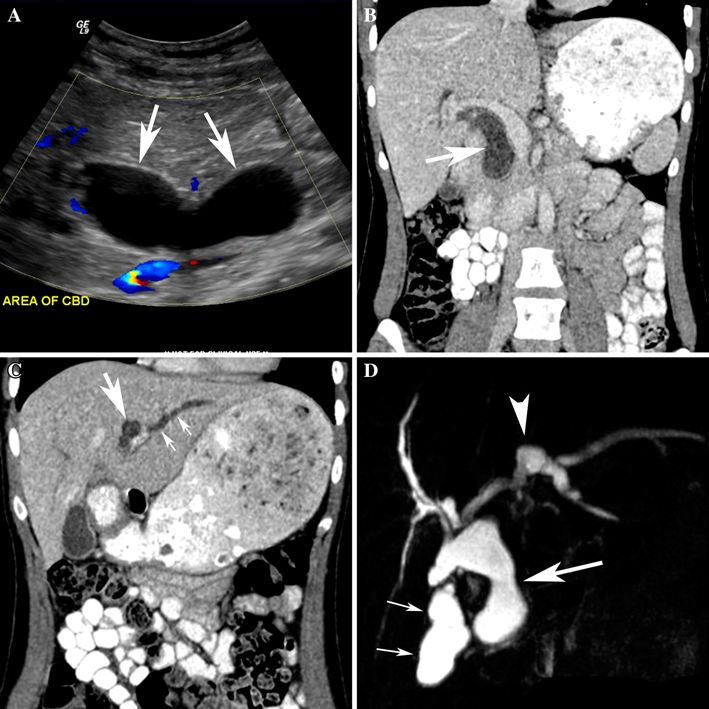 Pediatric choledochal cysts: diagnosis and current management | SpringerLink