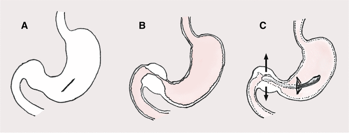Pyloric stenosis: an enigma more than a century after the first ...
