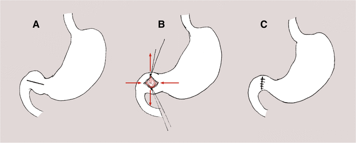 Pyloric stenosis: an enigma more than a century after the first ...