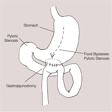 Pyloric stenosis: an enigma more than a century after the first ...