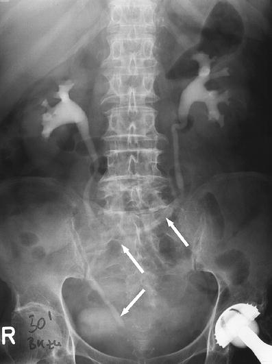 Transureteroureterostomy allows renal sparing radical resection of ...