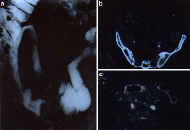The “creeping fat sign”—really diagnostic for Crohn’s disease ...