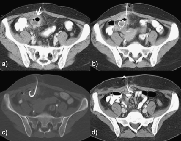 Influence of percutaneous abscess drainage on severe postoperative ...