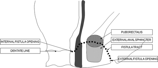 Non-cutting setons for progressive migration of complex fistula tracts ...