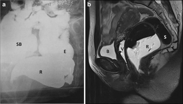 Dynamic MRI defecography vs. entero-colpo-cysto-defecography in the ...
