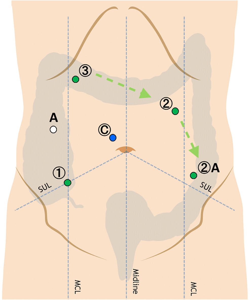 Robotic-assisted total mesorectal excision (TME) for rectal cancer ...
