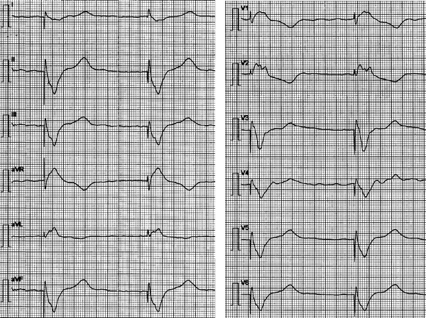 Loss of capture late after right ventricular pacing lead revision: what ...
