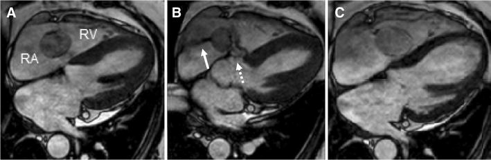 Gerbode ventricular septum defect covered by a ballooning membranous ...