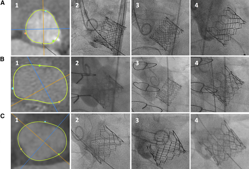 Late migration of Edwards SAPIEN 3 transcatheter heart valves ...