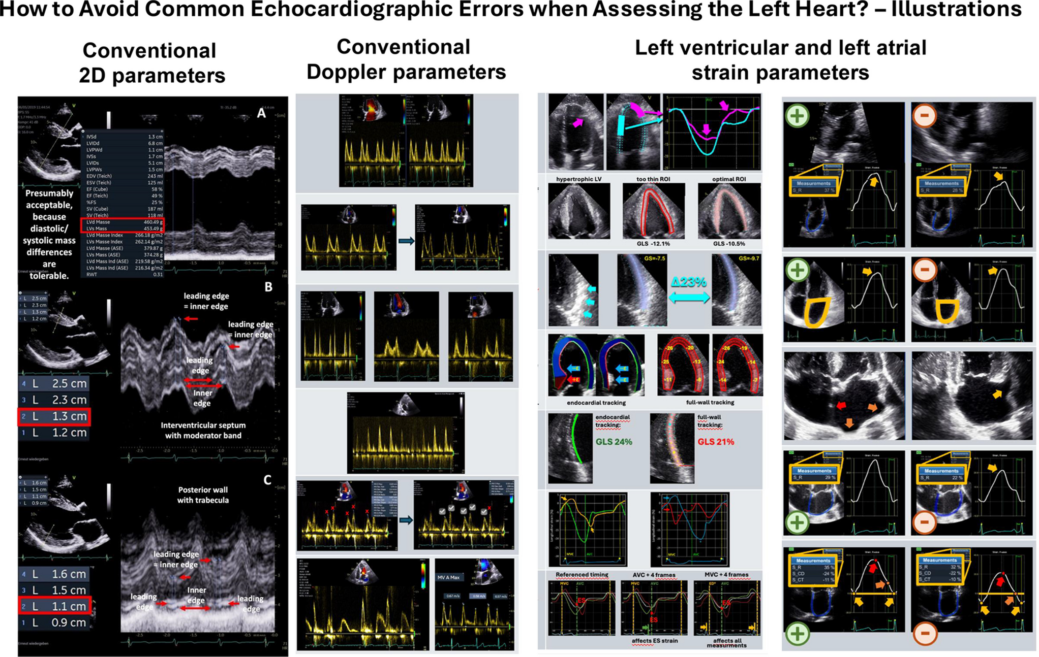 Echocardiography | How can common errors in left heart echocardiography ...
