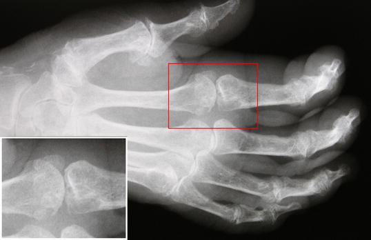 Kristallarthropathien – alt, aber wichtig | SpringerLink