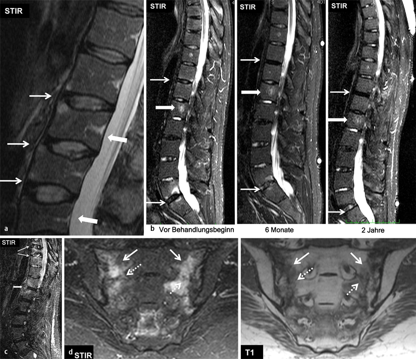 MRT-Untersuchungen bei axialer und peripherer Spondyloarthritis ...