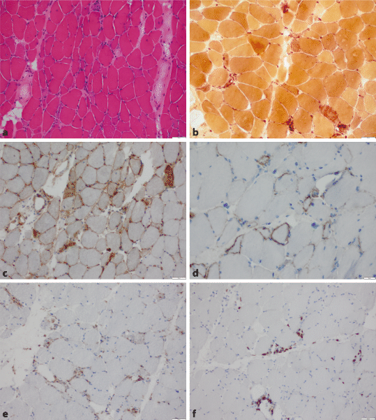 Immune-mediated necrotizing myopathy | SpringerLink