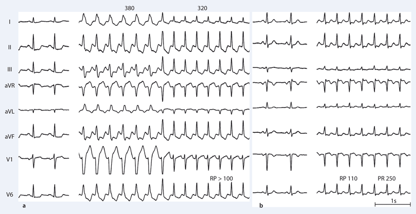 Concealed accessory pathways | SpringerLink