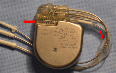 ICD-Elektroden | SpringerLink