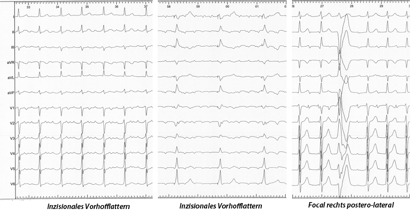 Oberflächen-EKG-Charakteristika von rechts- und linksatrialem Vorhofflattern | SpringerLink