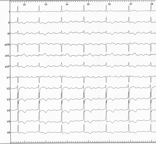 Oberflächen-EKG-Charakteristika von rechts- und linksatrialem Vorhofflattern | SpringerLink