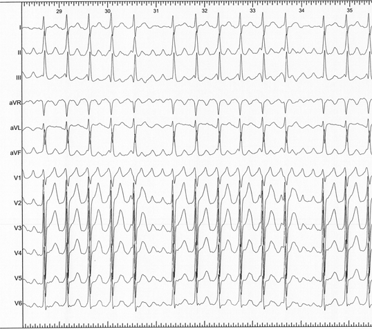 Oberflächen-EKG-Charakteristika von rechts- und linksatrialem Vorhofflattern | SpringerLink