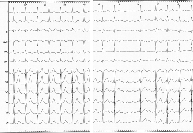 Oberflächen-EKG-Charakteristika von rechts- und linksatrialem Vorhofflattern | SpringerLink
