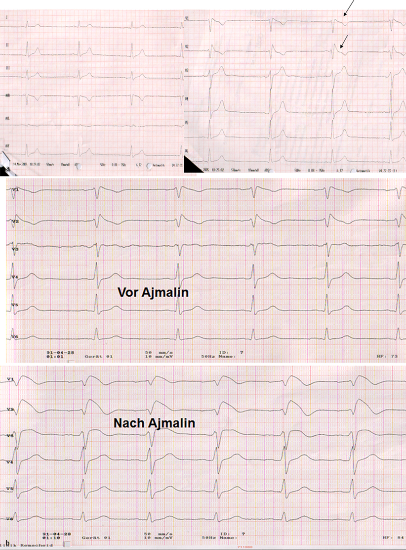 Das EKG beim Sportler | SpringerLink