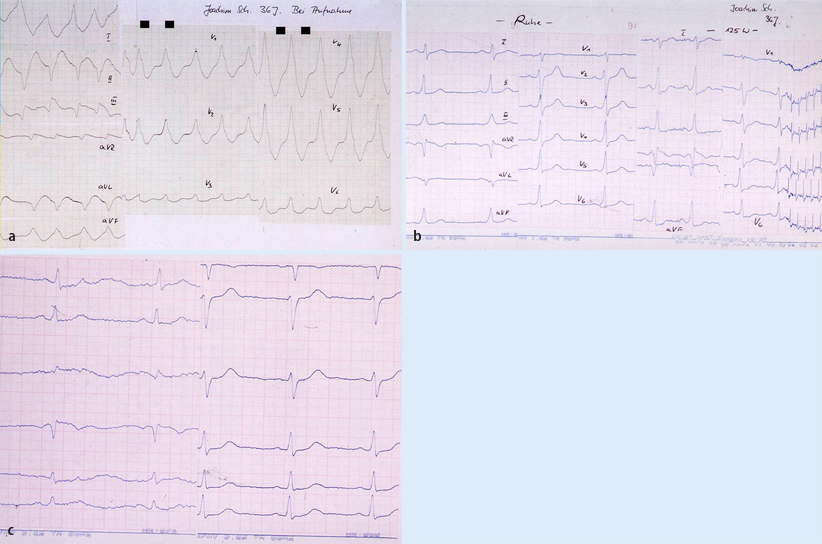 Das EKG beim Sportler | SpringerLink