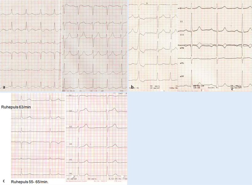 Das EKG beim Sportler | SpringerLink