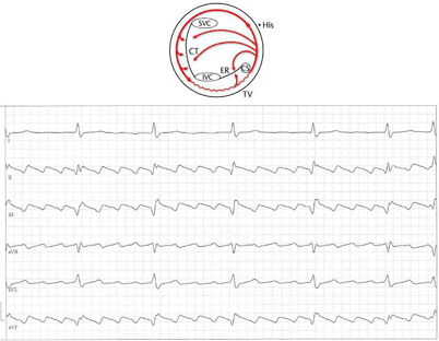 Typisches Vorhofflattern | SpringerLink
