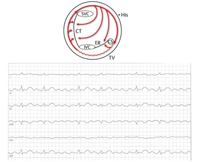 Typisches Vorhofflattern | SpringerLink