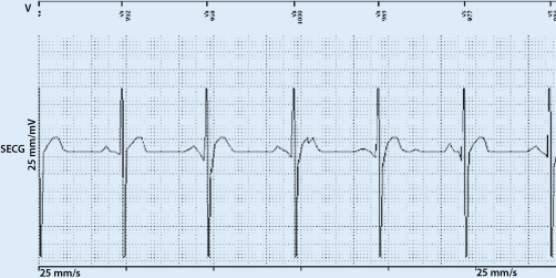 Implantierbarer Loop-Rekorder BioMonitor 2 (Fa. Biotronik) | SpringerLink