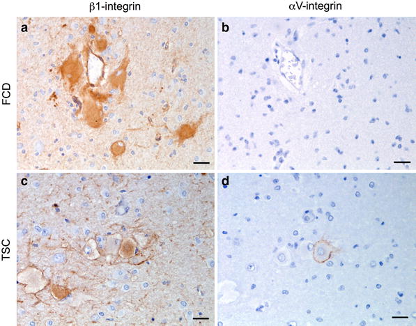 Balloon cells in human cortical dysplasia and tuberous sclerosis ...