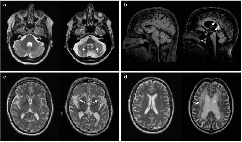 Fragile X-associated tremor/ataxia syndrome (FXTAS): pathology and ...
