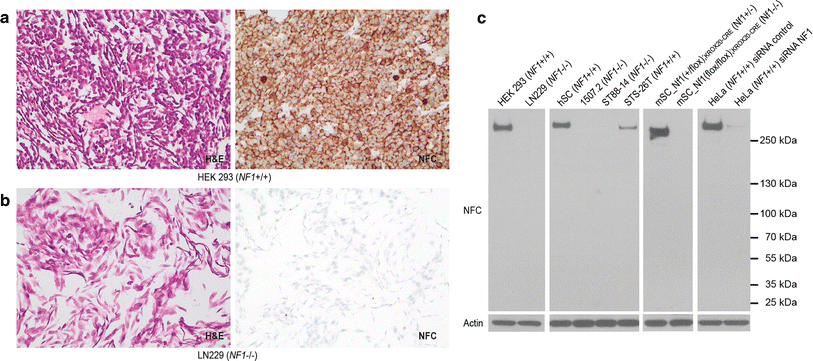 Neurofibromin specific antibody differentiates malignant peripheral ...