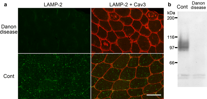 Danon disease: a phenotypic expression of LAMP-2 deficiency | SpringerLink