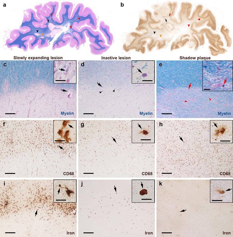 Slow expansion of multiple sclerosis iron rim lesions: pathology and 7 ...