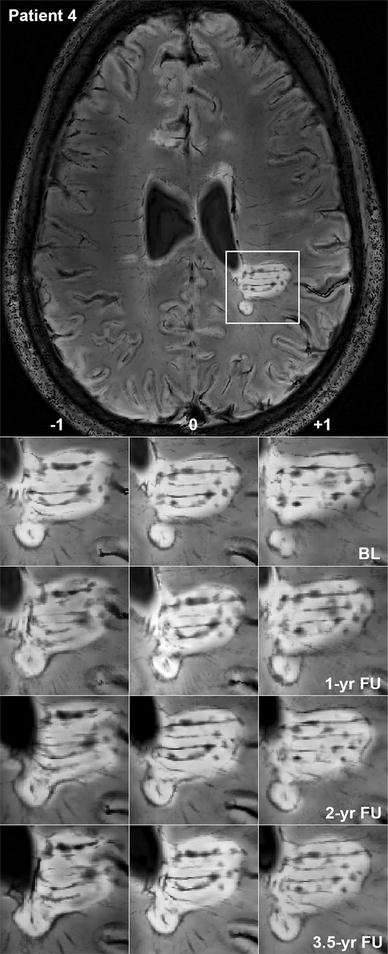 Slow expansion of multiple sclerosis iron rim lesions: pathology and 7 ...